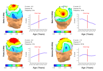 Discover the Benefits of QEEG Brain Mapping
